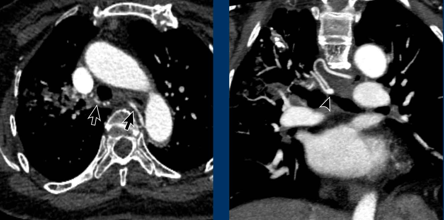 The Radiology Assistant : Cardiovascular Pearls on Chest CT.