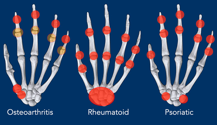 The Radiology Assistant : Arthritis