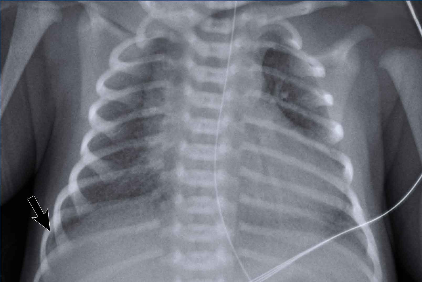 The Radiology Assistant : Neonatal Chest X-Ray