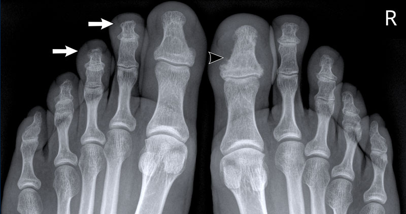 The Radiology Assistant : Arthritis