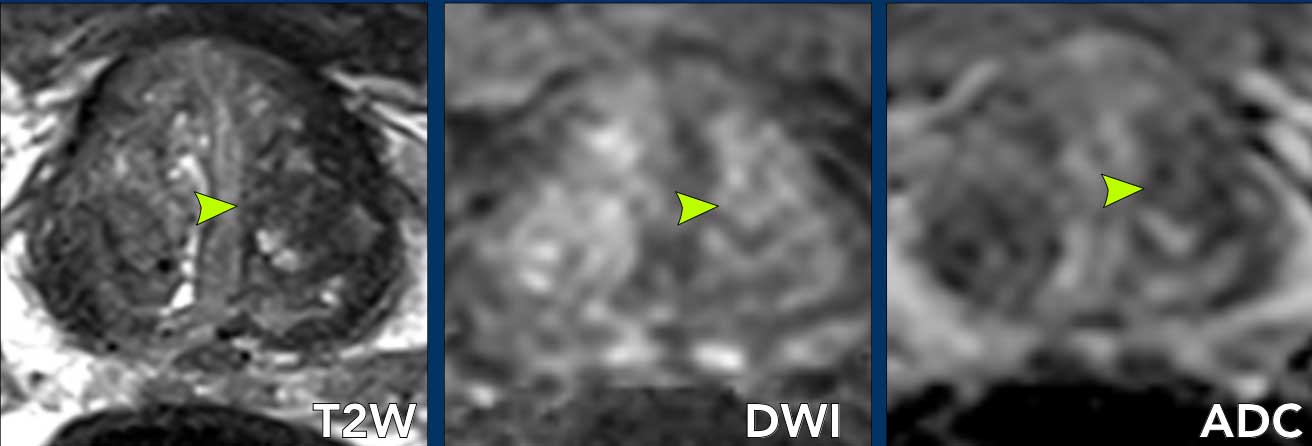 The Radiology Assistant : Prostate Cancer - PI-RADS v2.1