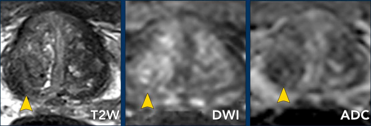 The Radiology Assistant : Prostate Cancer - PI-RADS v2.1