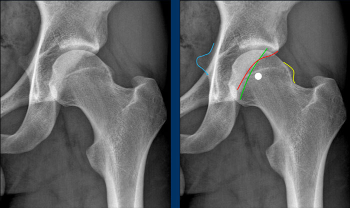 The Radiology Assistant : Femoroacetabular impingement syndrome