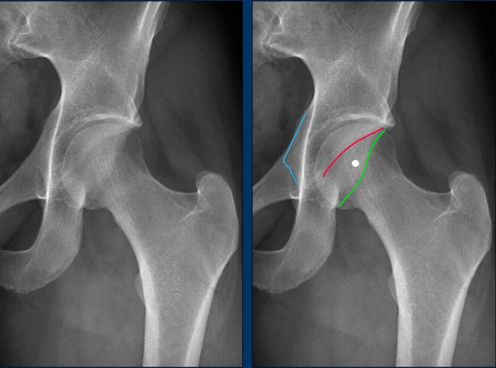 The Radiology Assistant : Femoroacetabular impingement syndrome