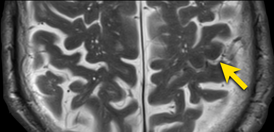The Radiology Assistant : Non-traumatic Intracranial Hemorrhage