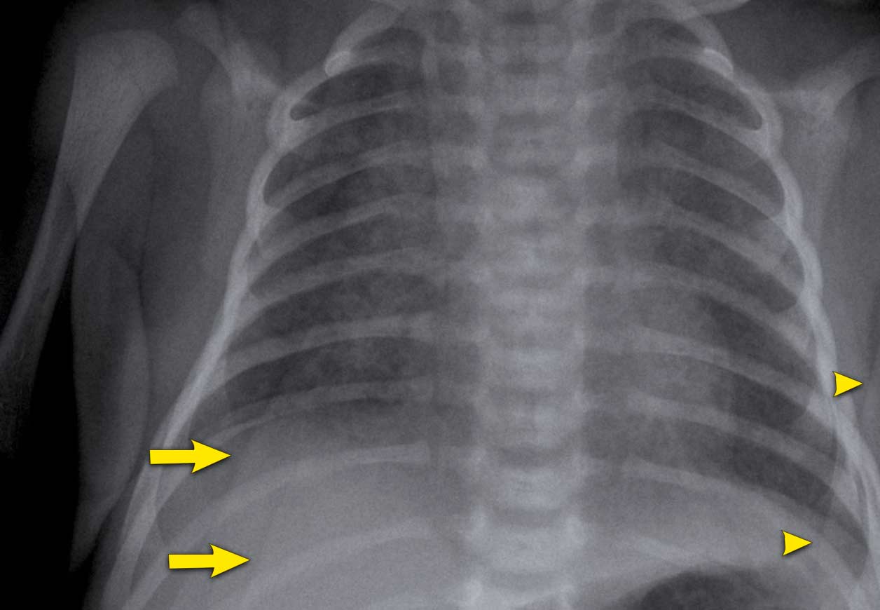 The Radiology Assistant : Neonatal Chest X-Ray