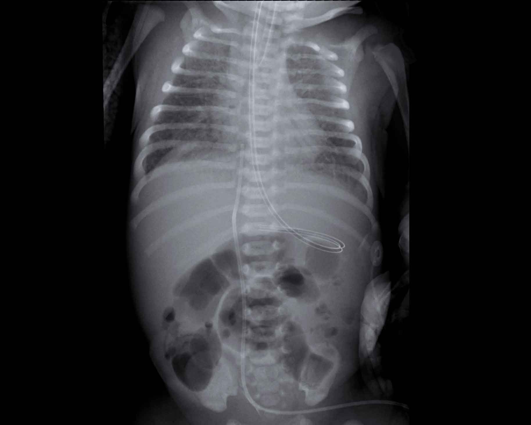 The Radiology Assistant : Neonatal Chest X-Ray