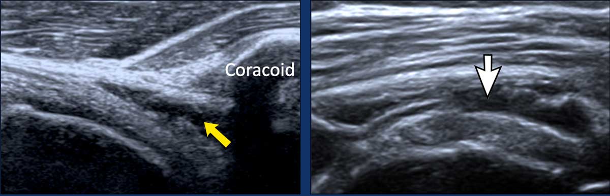 The Radiology Assistant : Shoulder Ultrasound