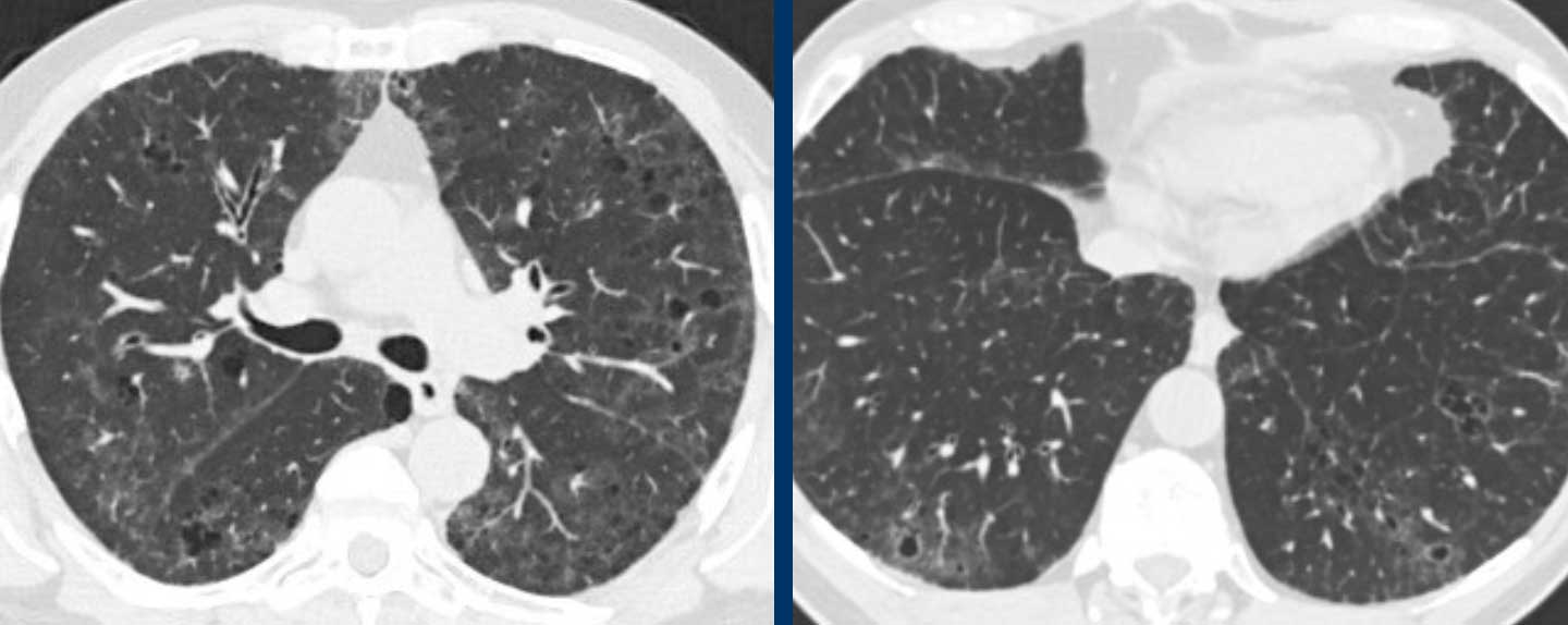 The Radiology Assistant : Cystic Lung Disease - Differential diagnosis