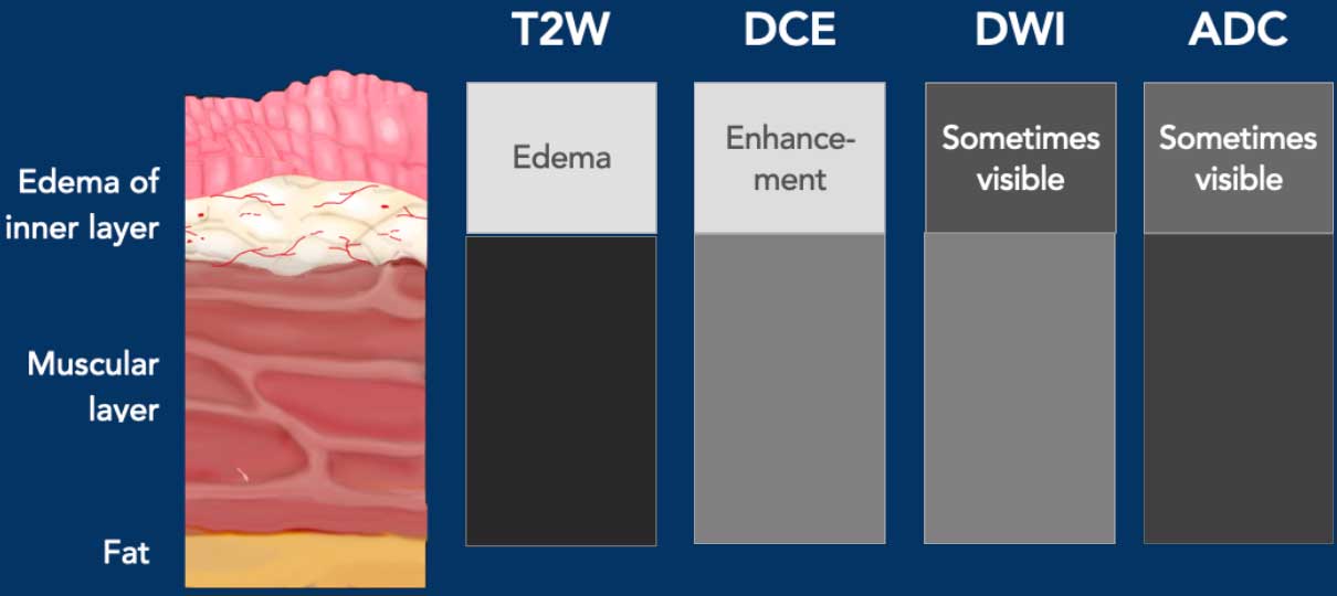 The Radiology Assistant : Bladder Cancer - VI-RADS