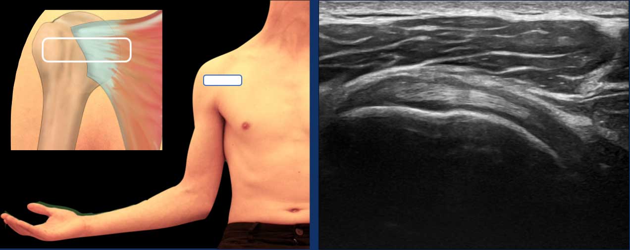 The Radiology Assistant : Shoulder Ultrasound