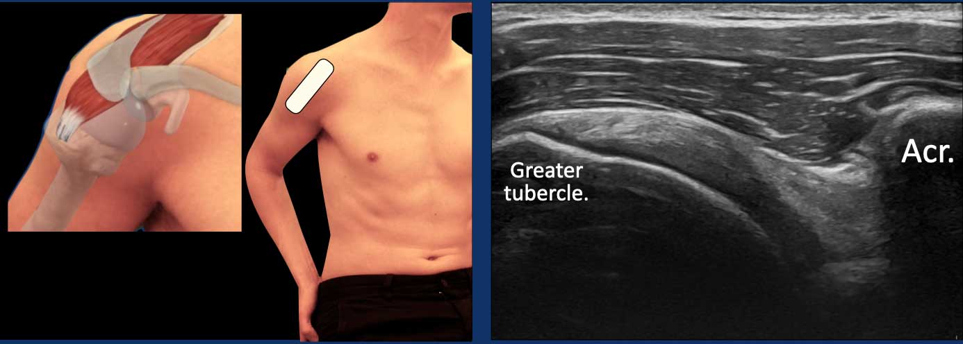 The Radiology Assistant : Shoulder Ultrasound