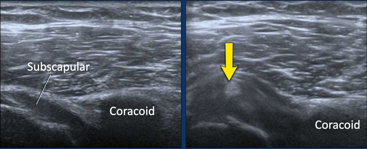 The Radiology Assistant : Shoulder Ultrasound