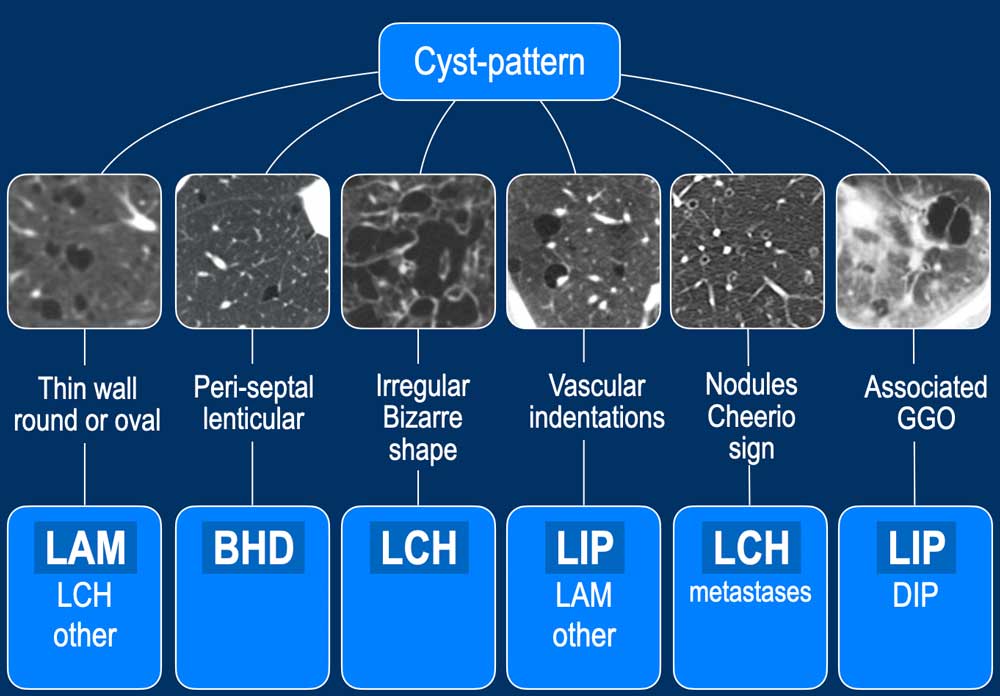 The Radiology Assistant : Cystic Lung Disease - Differential diagnosis