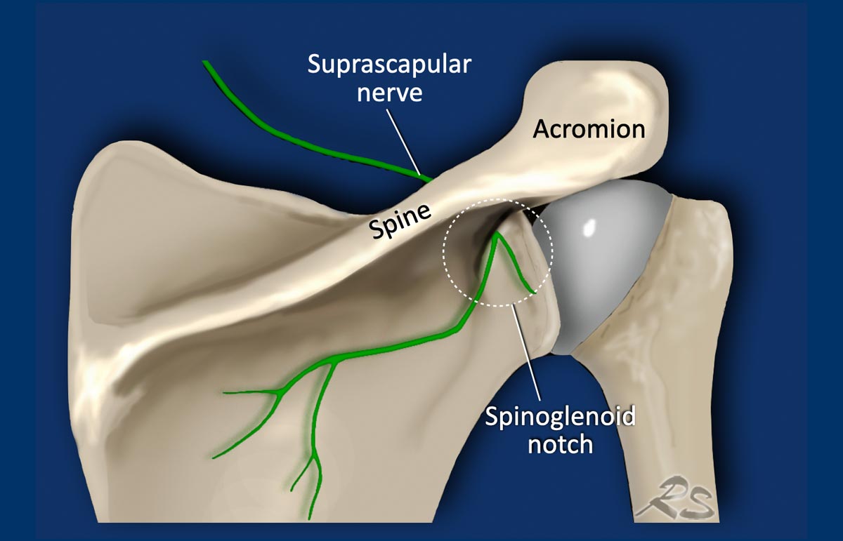 The Radiology Assistant : Shoulder Ultrasound