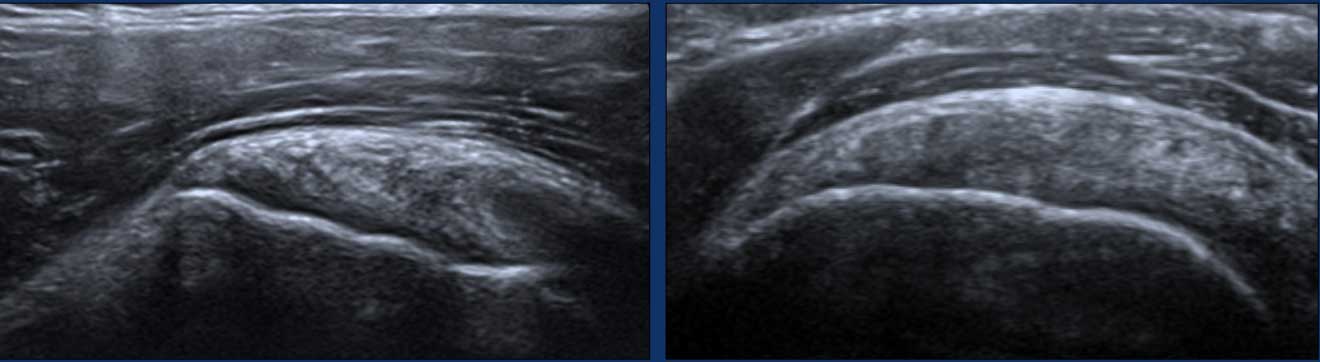 The Radiology Assistant : Shoulder Ultrasound