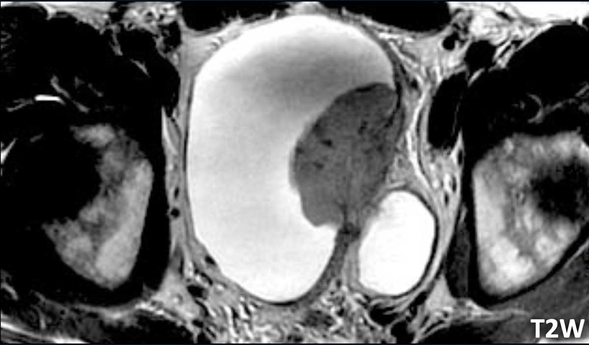 The Radiology Assistant : Bladder Cancer - VI-RADS