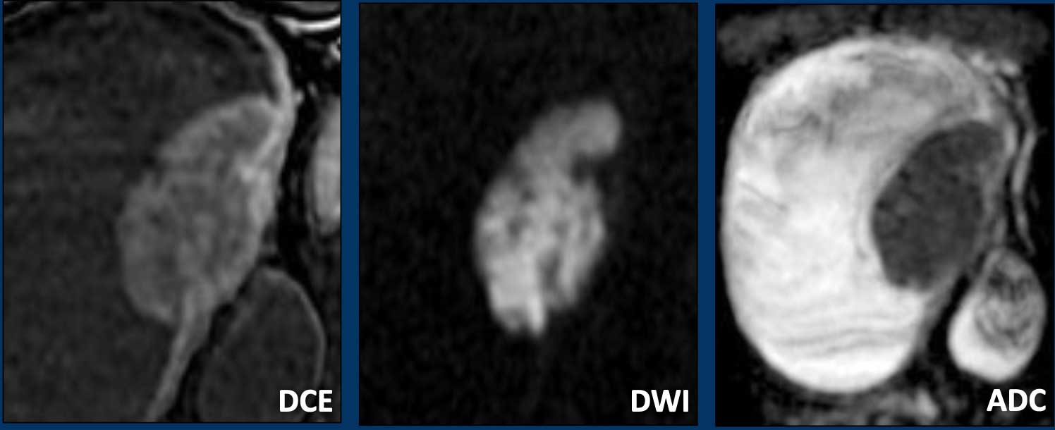 The Radiology Assistant : Bladder Cancer - VI-RADS