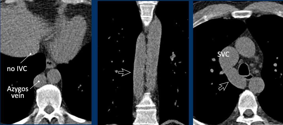 The Radiology Assistant : Cardiovascular Pearls on Chest CT...