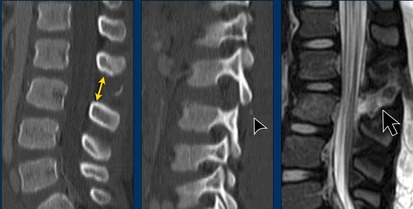The Radiology Assistant : AO Spine Classification of Thoracolumbar ...
