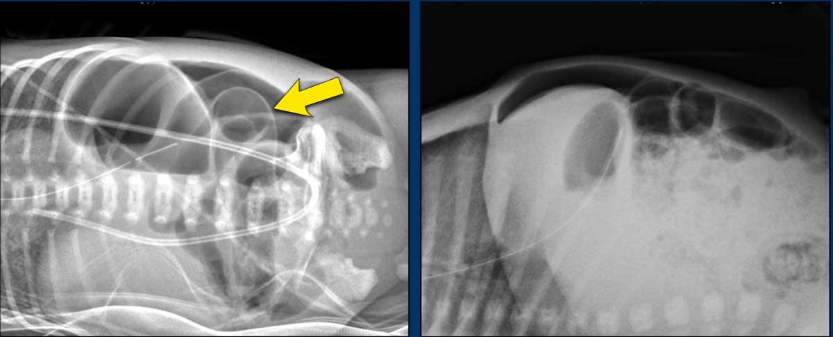 The Radiology Assistant : Necrotizing Enterocolitis