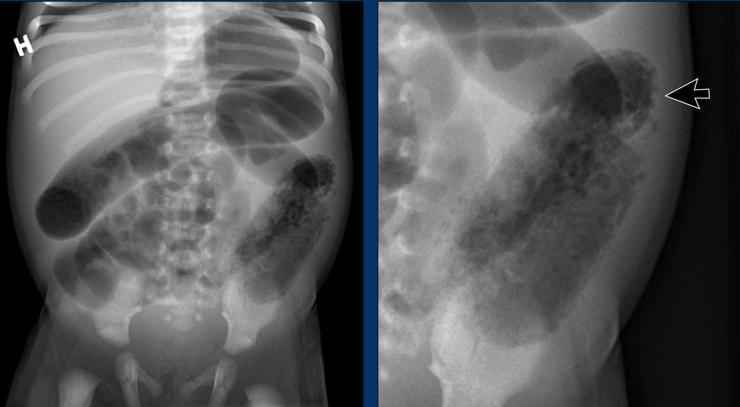 The Radiology Assistant : Necrotizing Enterocolitis