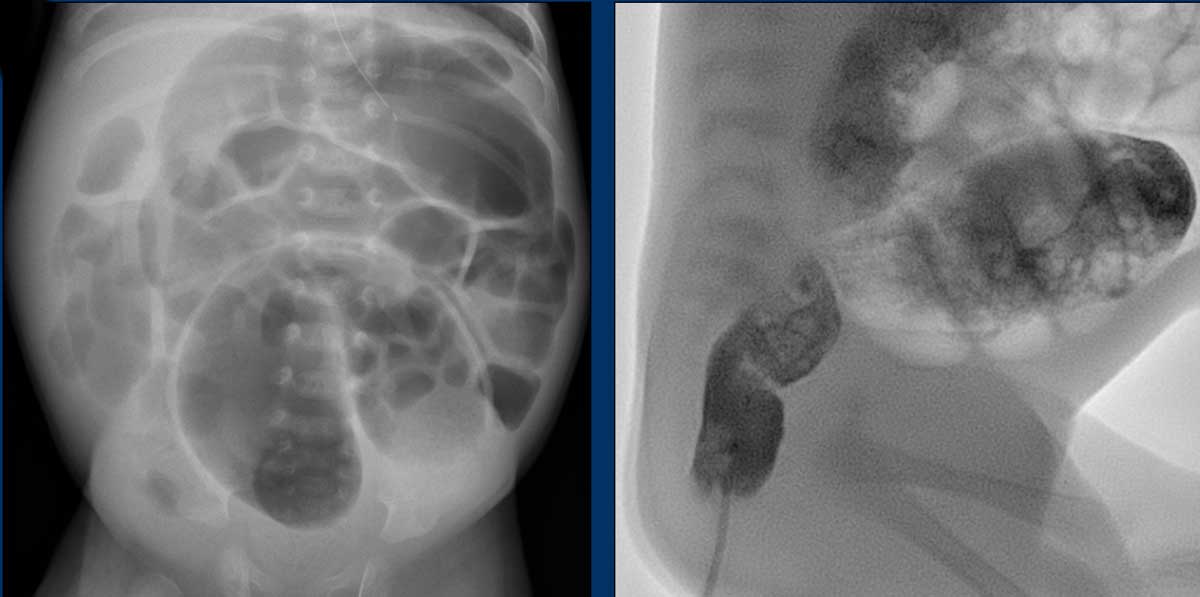 The Radiology Assistant : Necrotizing Enterocolitis