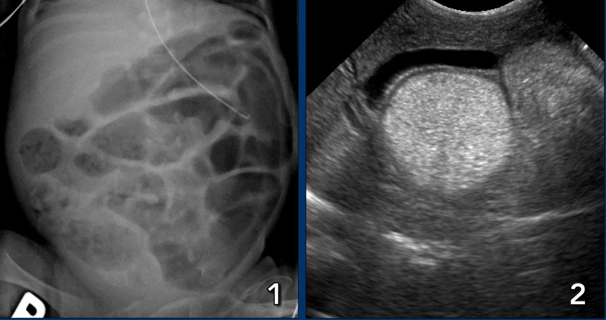 The Radiology Assistant : Necrotizing Enterocolitis