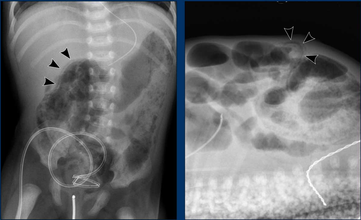 The Radiology Assistant : Necrotizing Enterocolitis