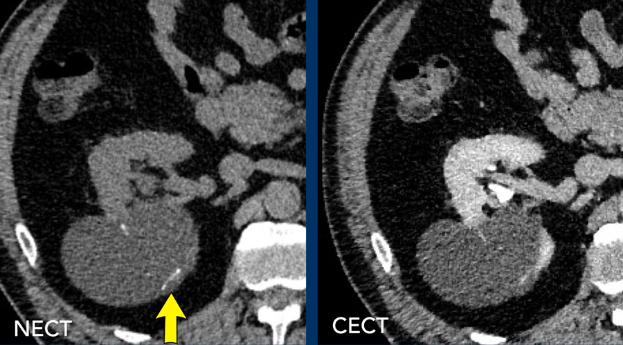 The Radiology Assistant : Bosniak Classification 2019