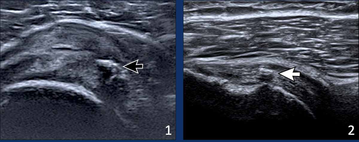 The Radiology Assistant : Shoulder Ultrasound