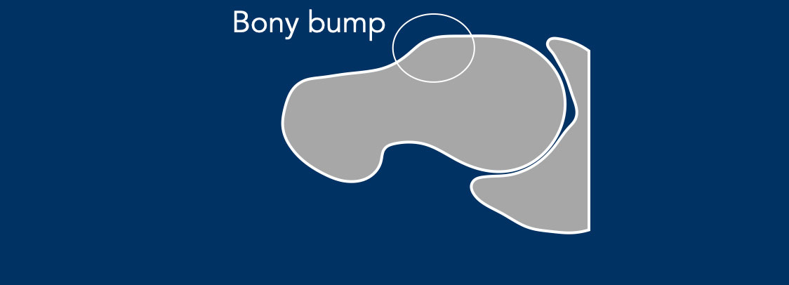 The Radiology Assistant : Femoroacetabular impingement syndrome