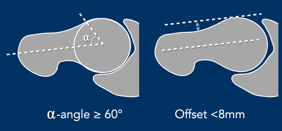 The Radiology Assistant : Femoroacetabular impingement syndrome