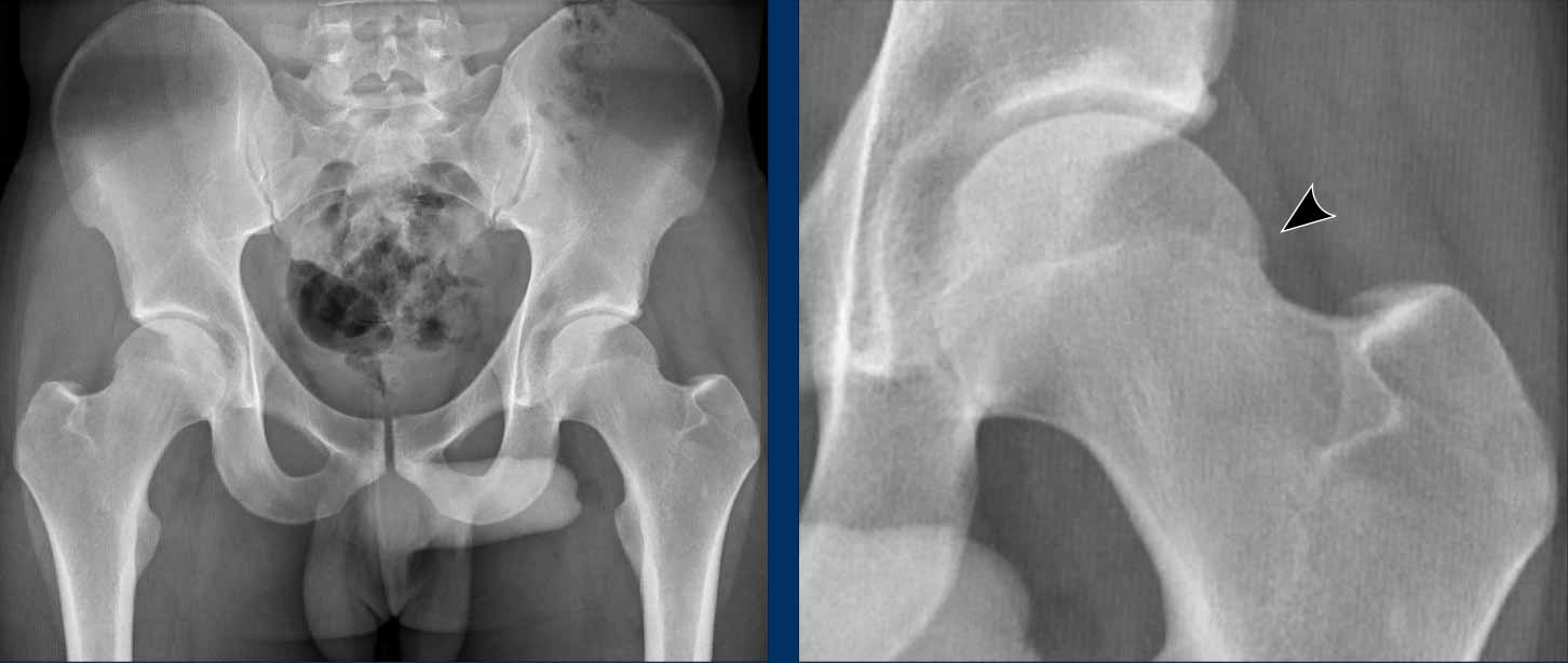 The Radiology Assistant : Femoroacetabular impingement syndrome