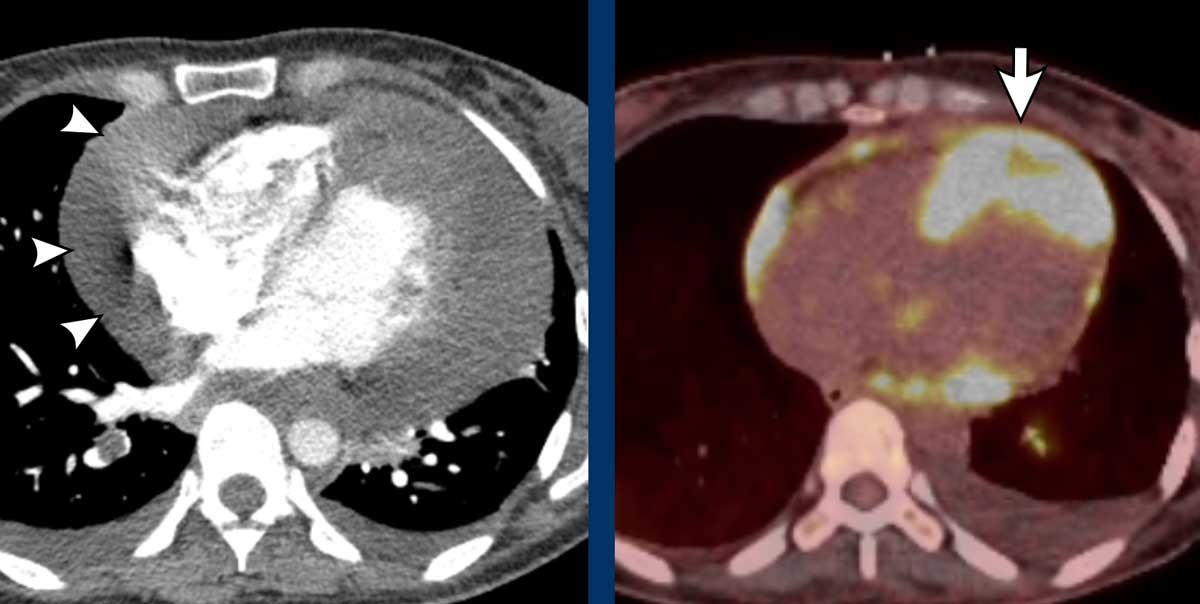 The Radiology Assistant : Cardiovascular Pearls on Chest CT...