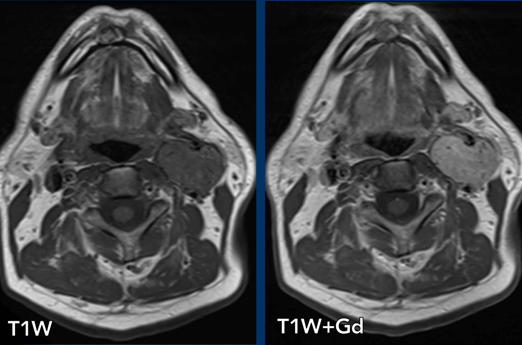 The Radiology Assistant : Horner syndrome