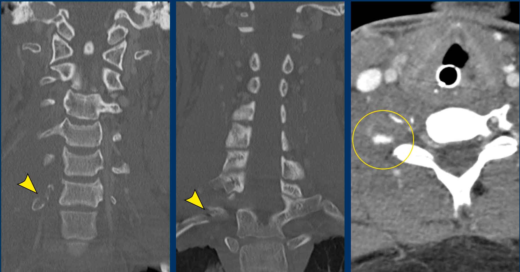 The Radiology Assistant : Horner syndrome.