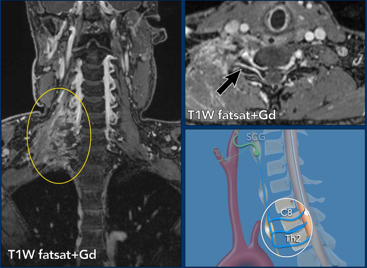 The Radiology Assistant : Horner syndrome.