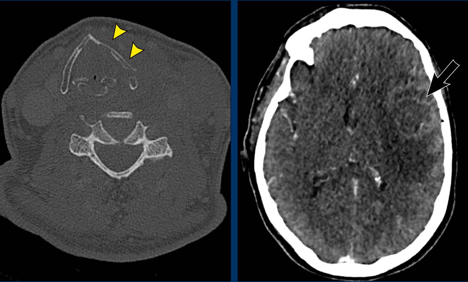 The Radiology Assistant : Horner syndrome