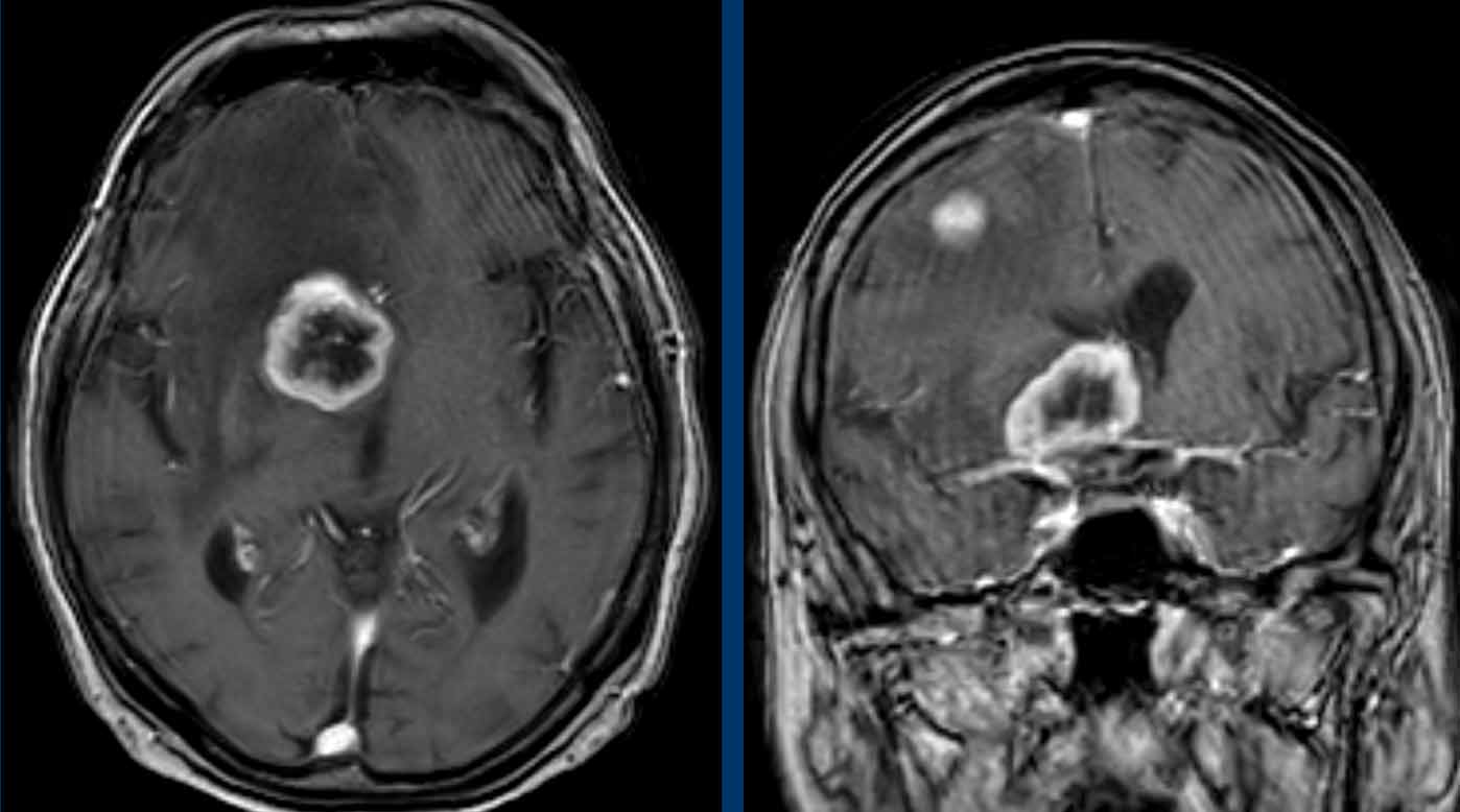 The Radiology Assistant : Horner syndrome