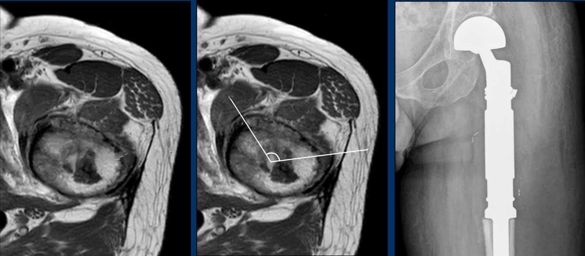 The Radiology Assistant : Cartilage tumors