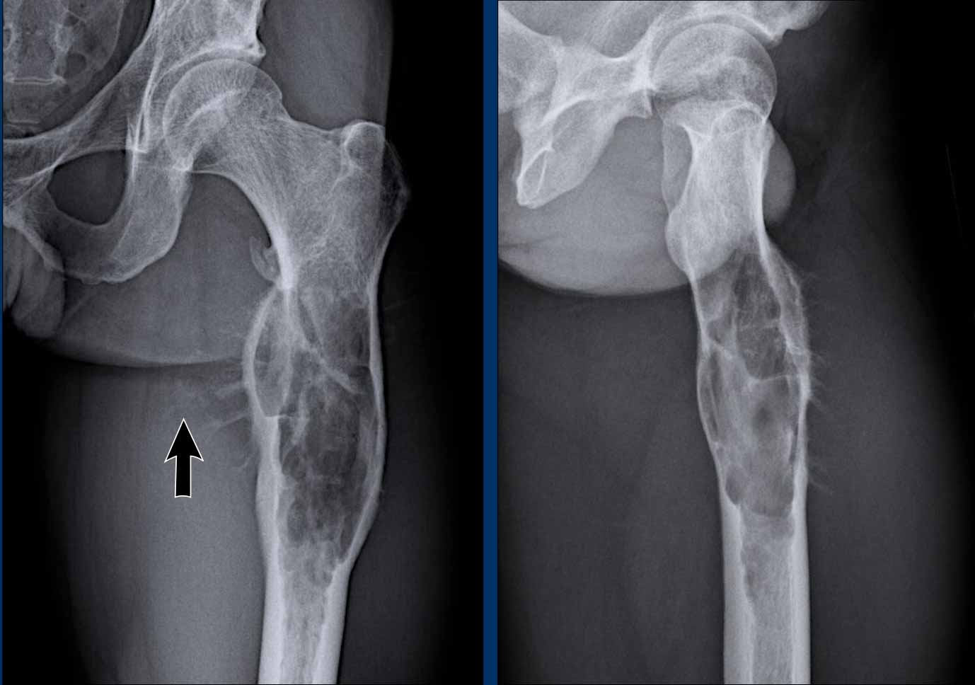 The Radiology Assistant : Cartilage tumors