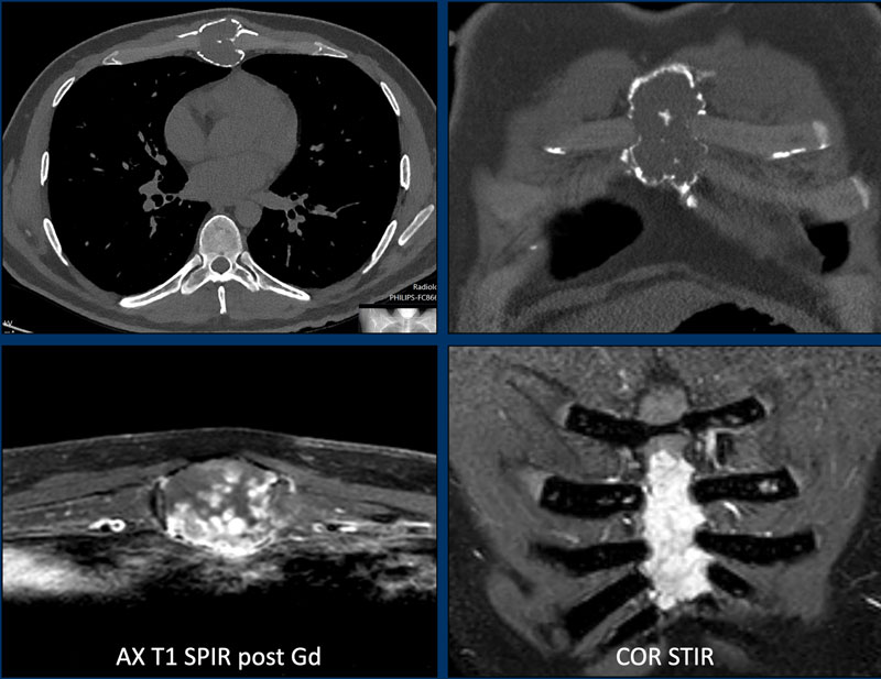 The Radiology Assistant : Cartilage tumors