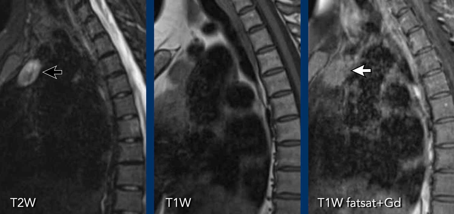 The Radiology Assistant : Thymic masses and mimics