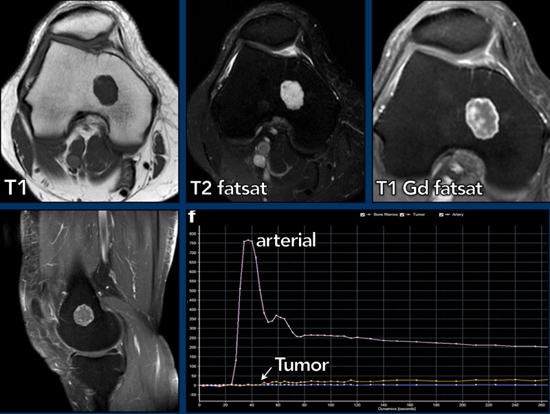 The Radiology Assistant : Cartilage tumors