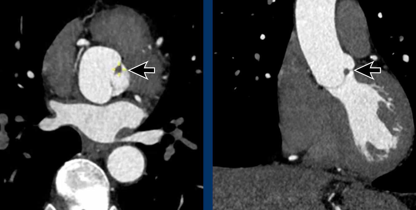 The Radiology Assistant : Cardiovascular Pearls on Chest CT...