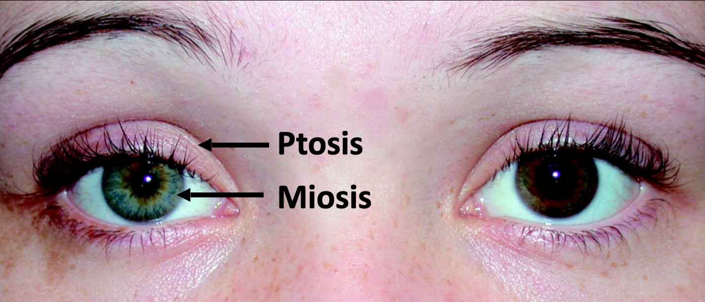 The Radiology Assistant : Horner syndrome