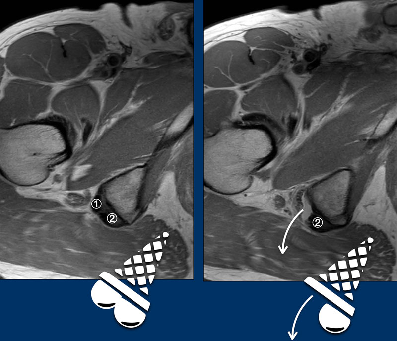 The Radiology Assistant : Hamstring injury