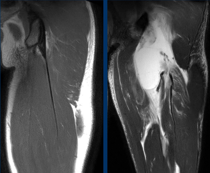 The Radiology Assistant : Hamstring injury