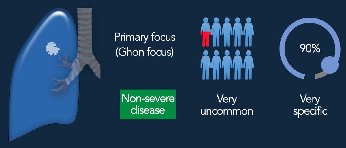 The Radiology Assistant : Imaging findings in TB